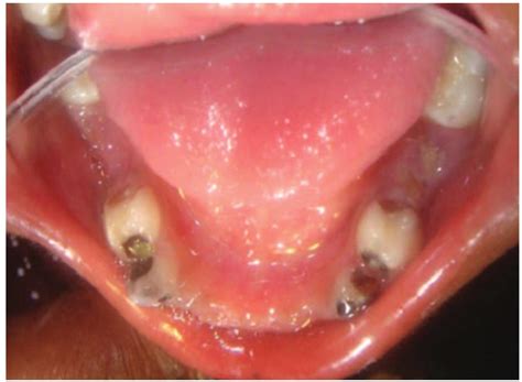 Preoperative Clinical Image Of Mandibular Arch