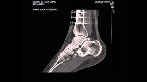 Ct Scan Of Ankle Youtube
