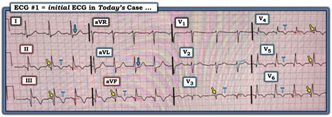 When Should You Get A Ct Scan On A Stemi Patient To Rule Out Aortic