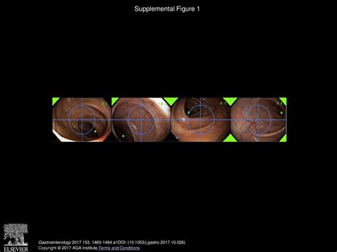 Will Computer Aided Detection And Diagnosis Revolutionize Colonoscopy
