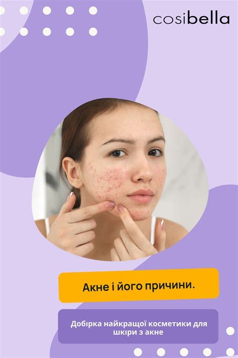 Як позбутися акне Найкращі інгредієнти і косметика для шкіри з акне в