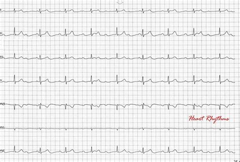 Block Heart Rhythm At Eldon Mills Blog