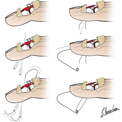 A D Surgical Incision Description A Bone Fragment And Angulation For