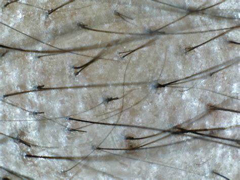 Androgenic Alopecia Research Articles My Research And Investigation Of Hair Loss