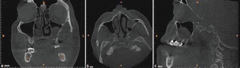 Cone Beam Computed Tomography Scan Showing Polypoidal Mucosal Download Scientific Diagram