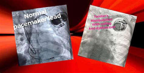 Twiddlers Syndrome An Uncommon And Dangerous Cause Of Pacemaker