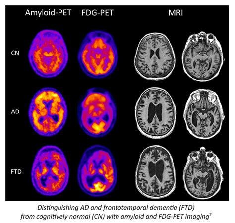 Alzheimers Disease Symptoms And Diagnosis Alzheimers Comorbidities