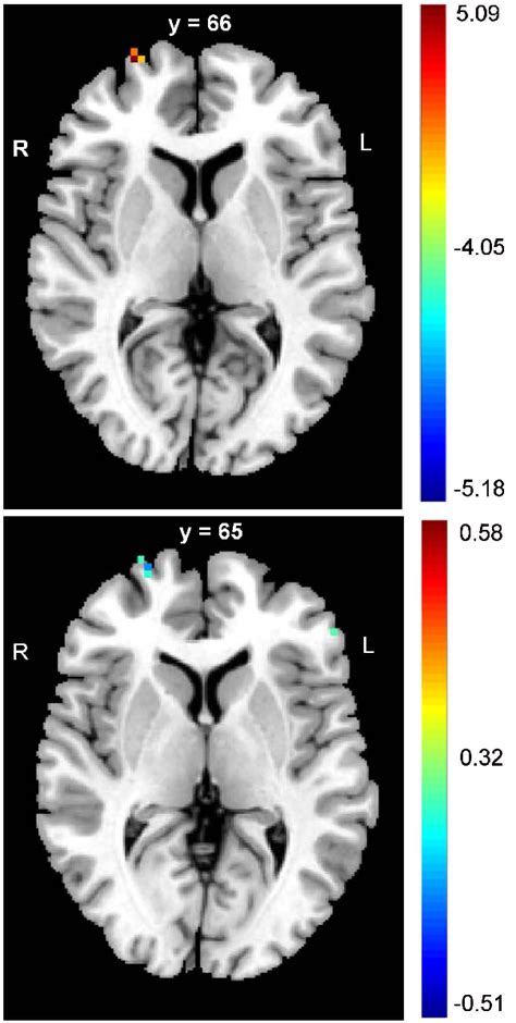 The Alterations Of Frontal Cortex In Dc Values Of Pd Patients The Pd