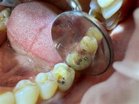 Tooth Buildup And Caries Treatment Using A Matrix System — Dental