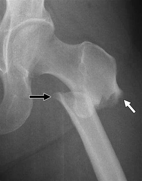 Bisphosphonate Fractures Radiology