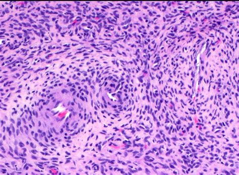 Jerad 45 Yo Man Lower Leg Subcutaneous Nodule Clinical Rule Out