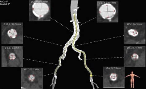 Tavi In A Patient With Tortuous Iliac Anatomy And Calcification