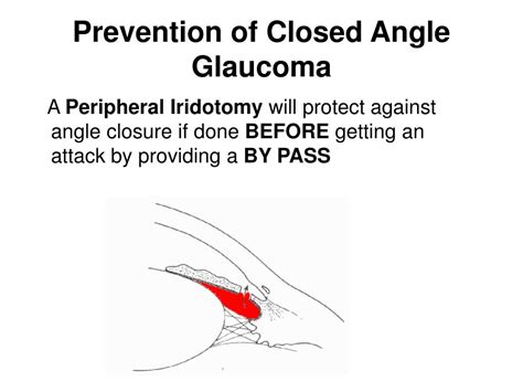 Ppt Acute Angle Closure Glaucoma Powerpoint Presentation Free