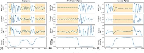 Figure 1 From Automated Detection Of Sleep Apnea Hypopnea Events Based On 60 Ghz Frequency