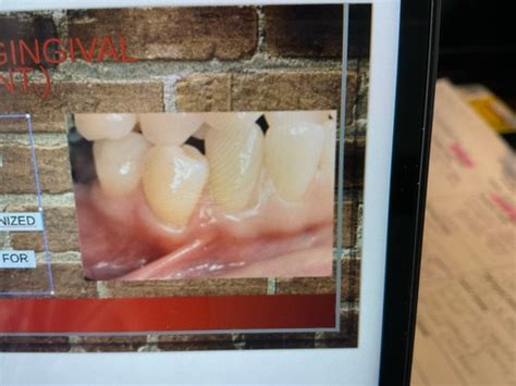 Periodontology Ch 7 Mucogingival Deformities And Conditions Around