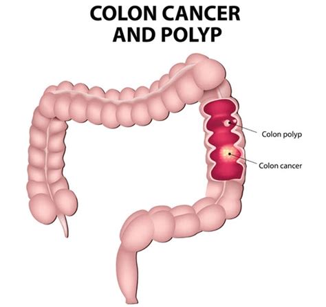 Conquer Colon Polyp Dx Coding For Clean Claims Icd 10