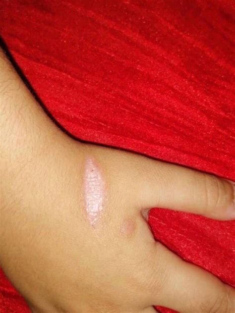 درمان سوختگی اتو سوختگی با اتو عکس سوختگی با اطو کلینیک التیام