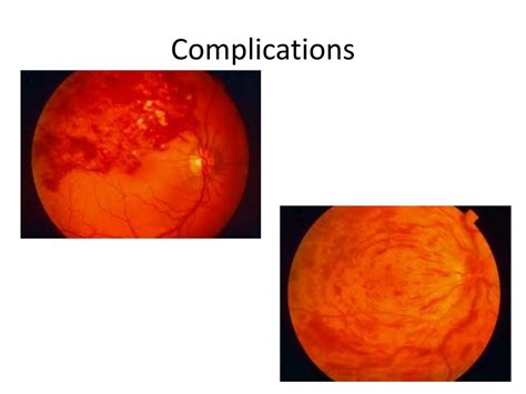Elschnig Spots Hypertensive Choroidopathy