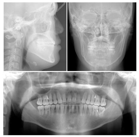 Non Surgical Camouflage Treatment Of A Skeletal Class Iii Patient With