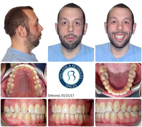 Impacted Upper Cuspids