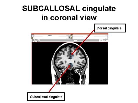 Anterior Cingulate The Anterior Cingulate Cortex Acc Resembles