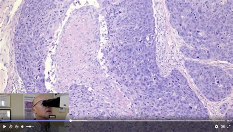 Basaloid Squamous Cell Carcinoma Dermpedia