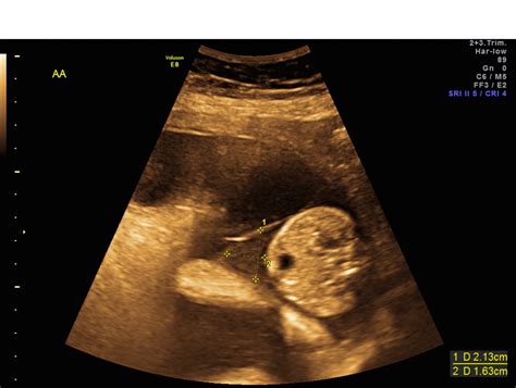 Twin Twin Transfusion Syndrome Ttts Obstetrics And Gynecology