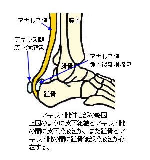 アキレス腱滑液包炎・ハグルンド病