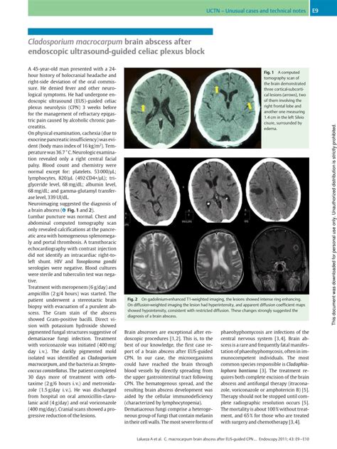 Pdf Cladosporium Macrocarpum Brain Abscess After Endoscopic Ultrasound Guided Celiac Plexus Block