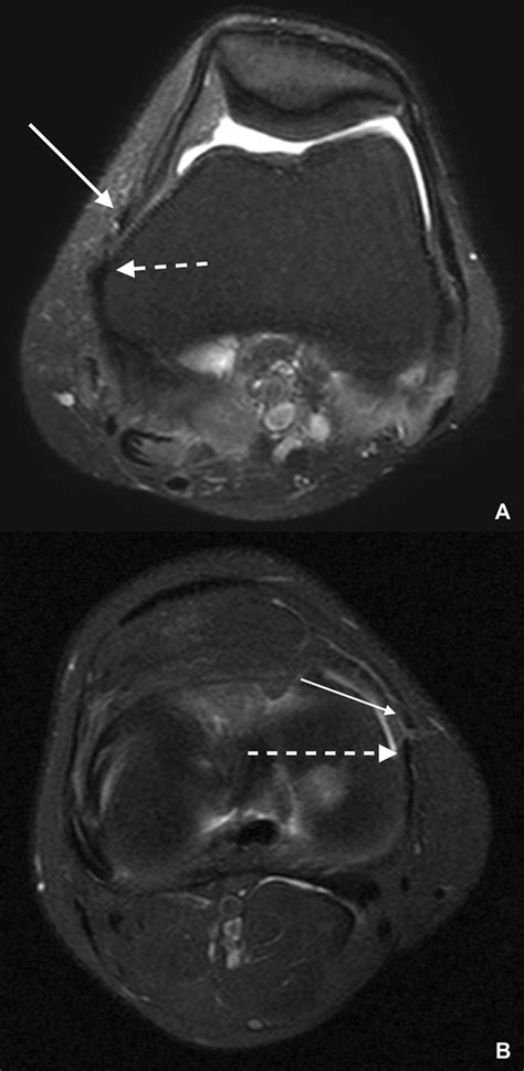 Mri Axial Scans Showing The Mcl Dashed Arrow And The Aol Closed