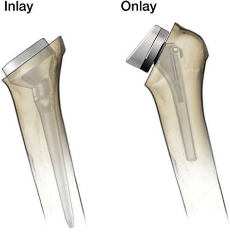 Reverse Shoulder Arthroplasty Design—inlay Vs Onlay Does It Really