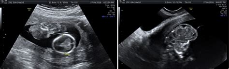 Ultrasound Examination At 14 Weeks And Two Days Note Download
