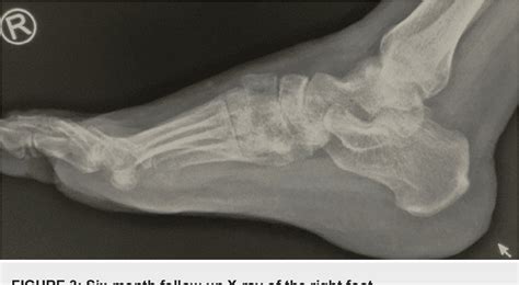 Figure 3 From The Management Of Navicular Dislocation And Multifocal Fractures Following A Fall