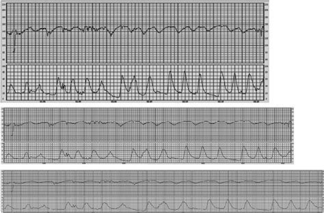 Reduced Variability The Baseline Is Affected By Contractions Causing Download Scientific
