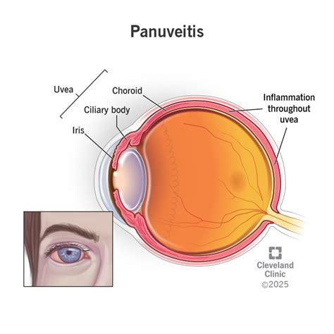 Panuveitis What It Is Causes Symptoms And Treatment