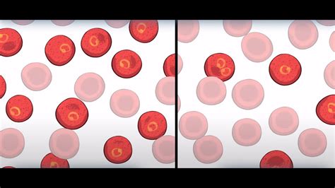 Sickle Cell Natural Selection In Humans Hhmi Biointeractive Video Go It