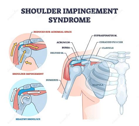 Shoulder Impingement Diagnosis