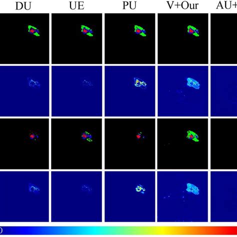 The Visual Comparisons Of MRI Brain Tumor Segmentation Results With Download Scientific Diagram