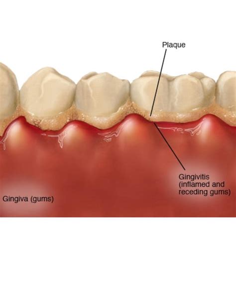Gum Disease Chart Gingivitis Oral Disease Oral Healrh Fight Gum