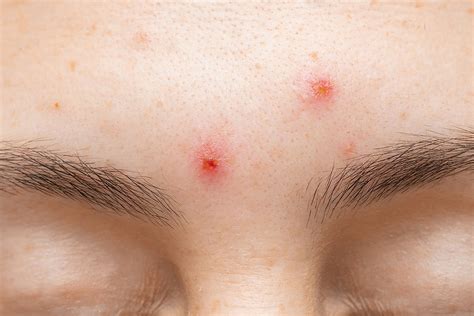 Shingles In Eye Lid At Thomas Lawson Blog