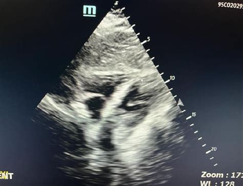 B 4 Chamber 2d Echo Showing Subcostal View Download Scientific Diagram