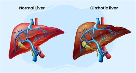 Primary Biliary Cholangitis Treatment And Research Innovations Medtigo