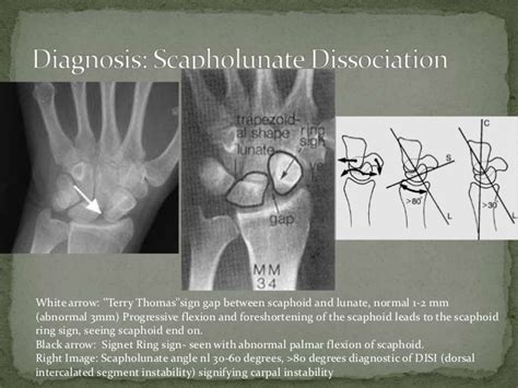 Scapholunate Dissociation 1