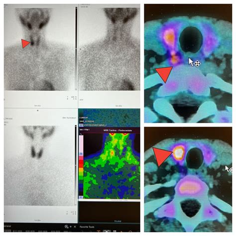 Synchronous Parathyroid Adenoma And Thyroid Papillary Carcinoma Parathyroid Scintigraphy