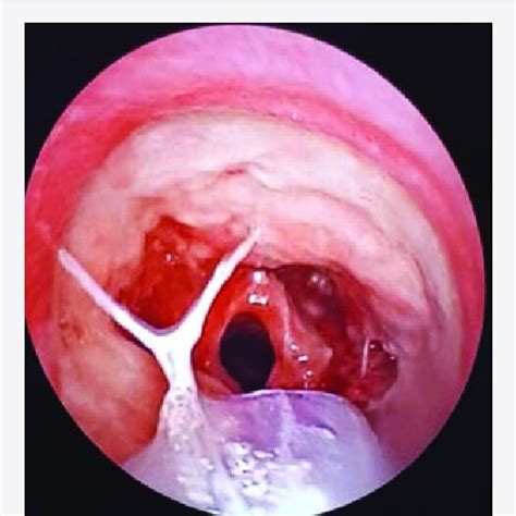 Fiberoptic Bronchoscopy Demonstrated Complete Tracheal Separation Download Scientific Diagram