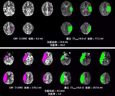 Ct灌注成像对缺血性卒中再通结果的预测研究 Crisp研究 脑医汇