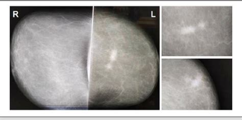 Figure 1 From Radiation Induced Breast Angiosarcoma After Breast Cancer