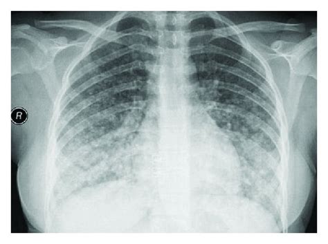 In The Chest Radiography Widespread Nodular Opacities Are Seen In All