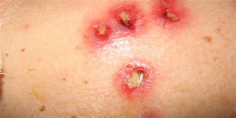 Ecthyma Definition Of Ecthyma