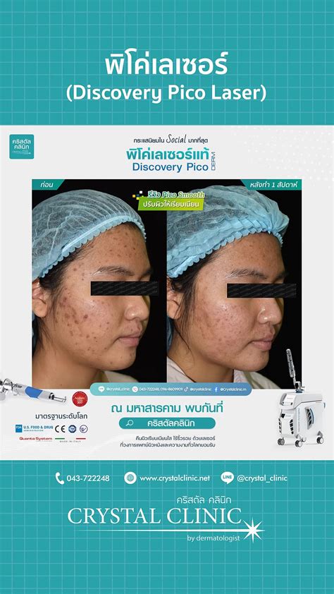 เคสรีวิว พิโค่เลเซอร์ปรับผิวเรียบเนียนขาวใส Discovery Pico Laser นวัตกรรมเลเซอร์ที่ล้ำสมัย